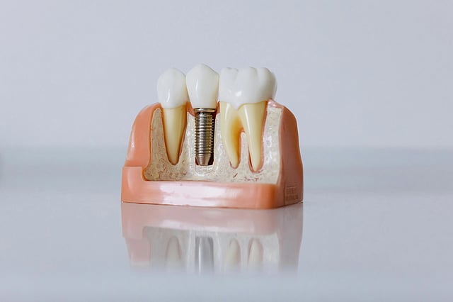 10 Questions to Ask Before Getting Dental Implants