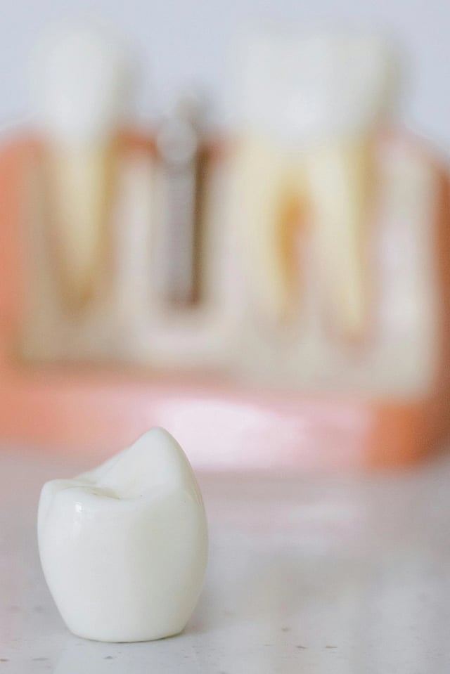 10 Questions to Ask Before Getting Dental Implants