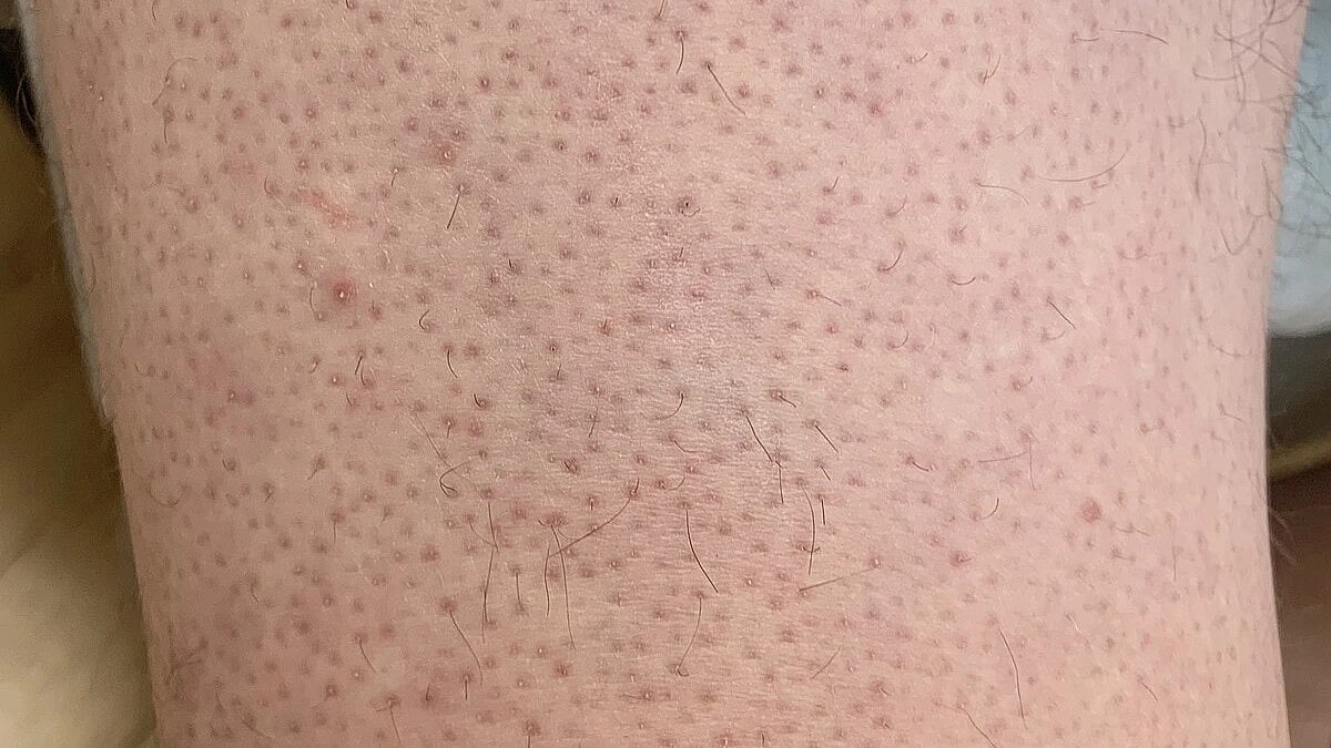 Strawberry Skin: Dermatologist-Approved Treatments, Causes, Prevention