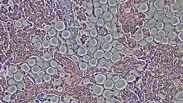 Cancer Treatment Dramatically Reduces HIV-Infected Immune Cells