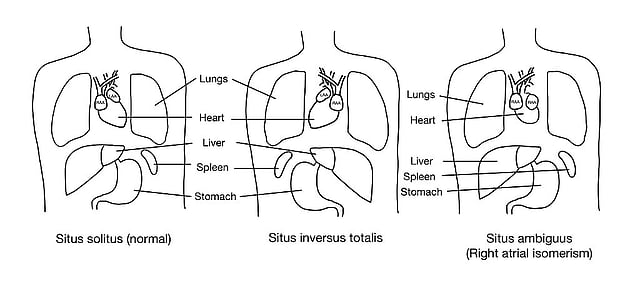 Catherine O’Hara Death Highlights Situs Inversus and Dextrocardia