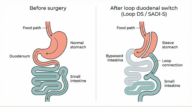 Loop Duodenal Switch Cost in Denver: LDS Surgery Price Guide 2026