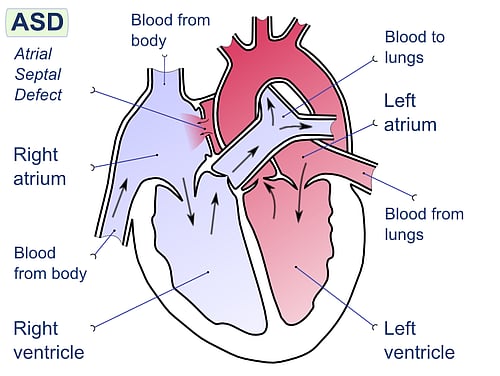 Five Most Common Congenital Heart Defects | CHD Awareness Week 2026