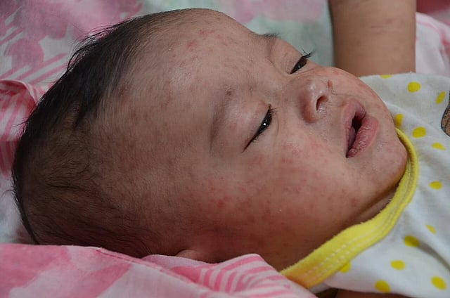 Measles Surge in U.S.: Texas ICE Center Quarantined Amid Outbreak
