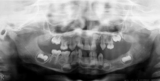 Doctor Identifies Gene Mutation Behind Family’s Missing Teeth
