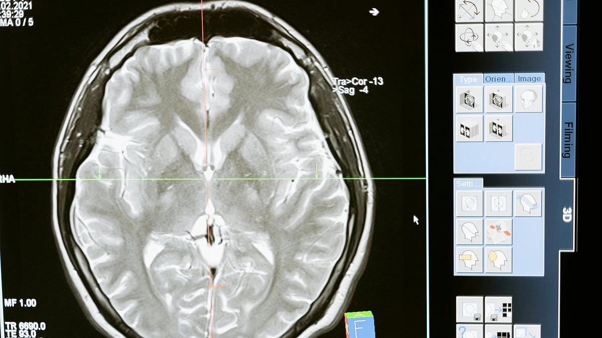 Snake Parasite Found in Human Brain for First Time
