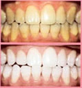 Best Teeth Whitening Kits 2026: Types, Safety & How They Work
