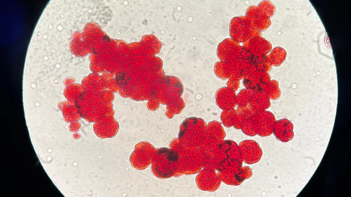 New Target Identified to Improve CAR T-Cell Therapy in Blood Cancers