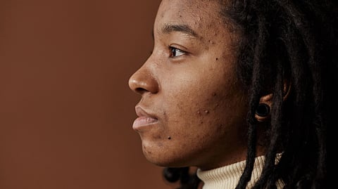 “Just Stress or Skincare”: Diagnostic Gaps in PCOS and PMDD
