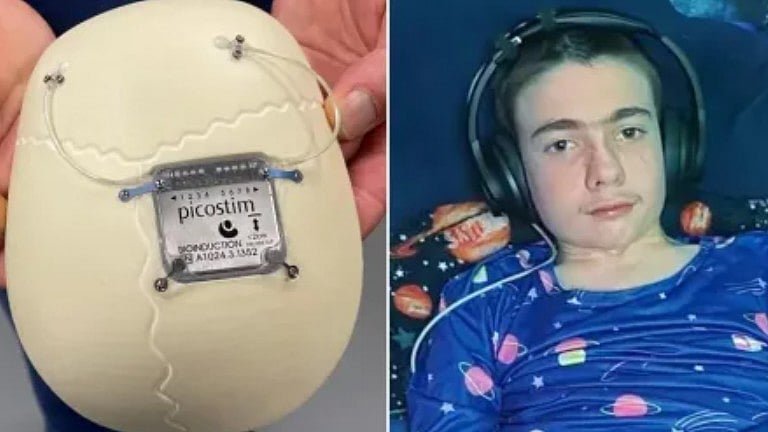 Schoolboy in England gets world's first epilepsy device fitted in skull