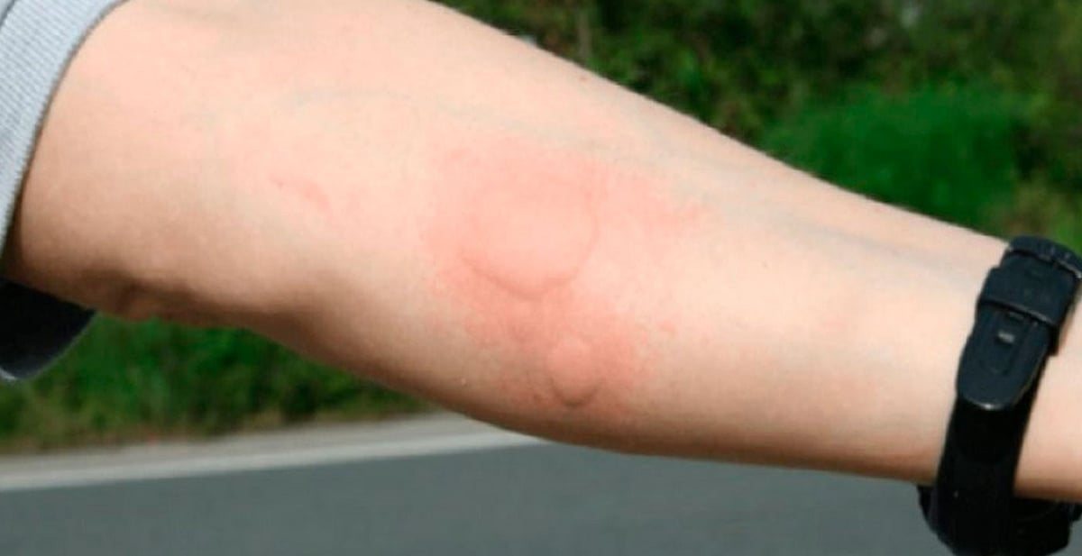 ¿Qué hacer en caso de picadura de alacrán? Consejos de la Secretaría de ...