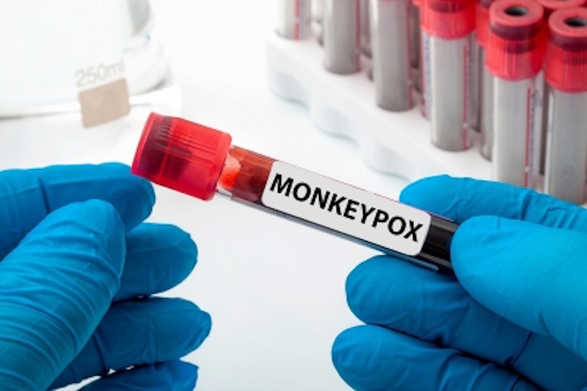 New Zealand confirms first two monkeypox cases of community transmission