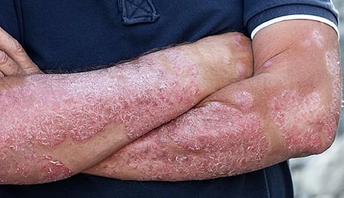 Study shows chronic skin ailment psoriasis may raise heart disease risk