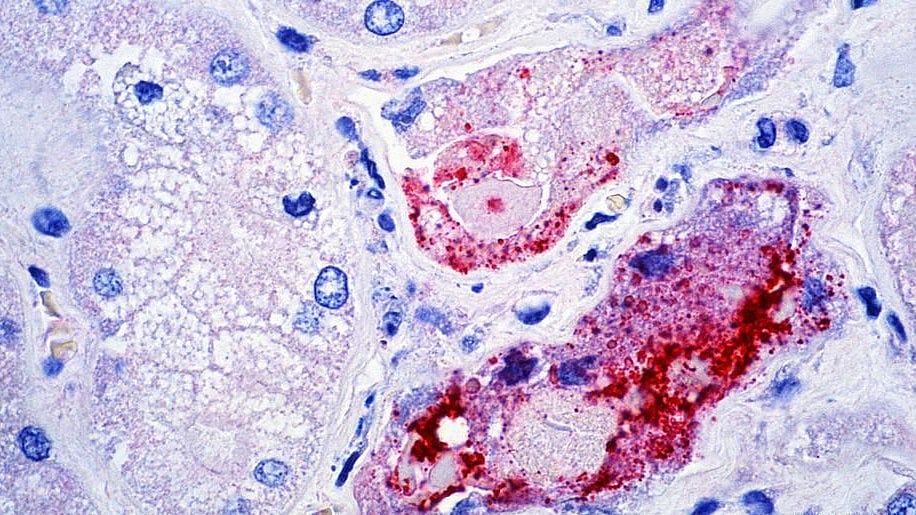 Two nurses with Nipah virus critical in Kolkata hospital