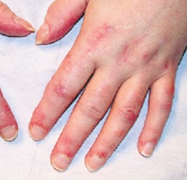 Delving into Dermatomyositis