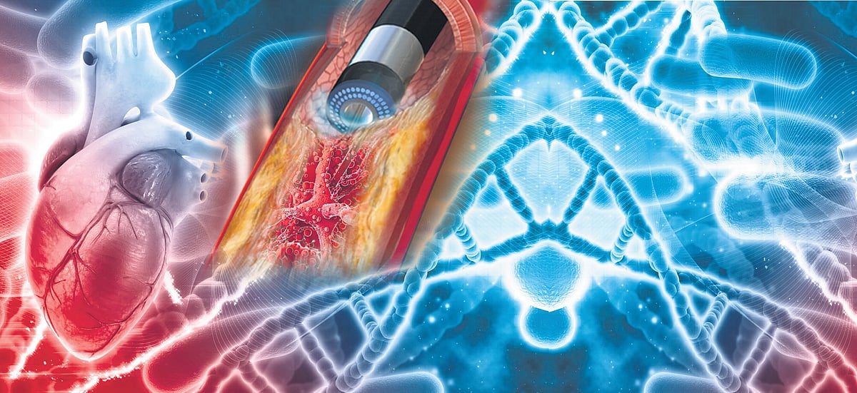 Laser angioplasty to clear blocks with precision