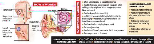 Cochlear implants: Turning deaf ear to hearing issues can impair speech ...