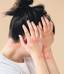 Why this new study offers greater relief to India's psoriasis patients