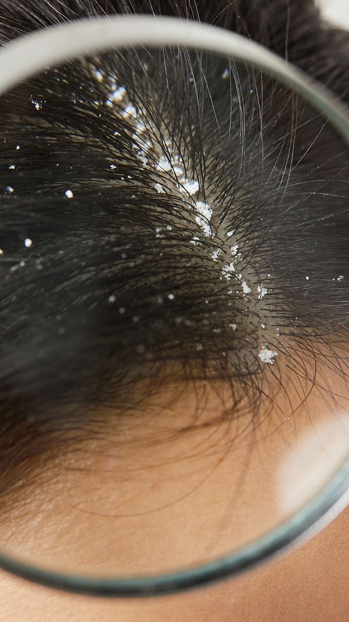 dandruff in winter; थंडीत केसात अधिक कोंडा होतोय, जाणून घ्या कारण अन् ...