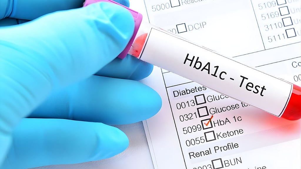 HbA1c test | दक्षिण आशियात 'HbA1c' चाचणीमुळे मधुमेहाचे निदान चुकण्याची ...