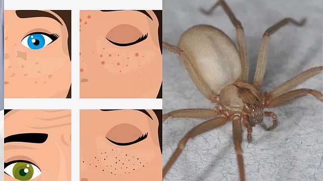 சிலந்தி கடித்ததால் கடும் அவதிக்கு ஆளான அமெரிக்க பெண்/us woman suffers ...