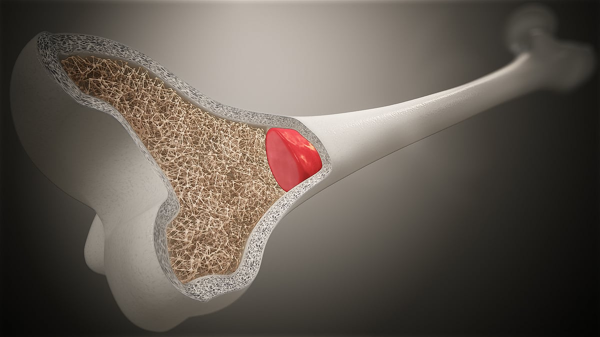 Bone Marrow Disorders: Early Warning Signs of Blood Cancer