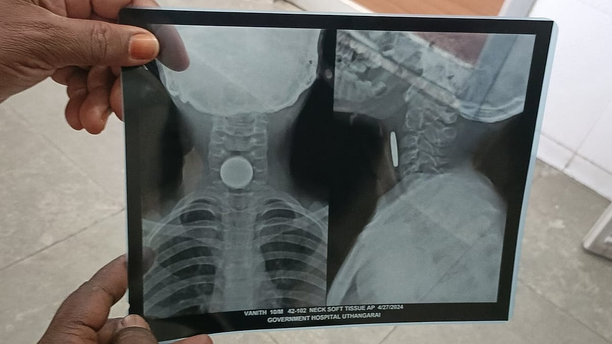 The ₹5 coin that the boy had swallowed at the mouthpiece was removed by ...