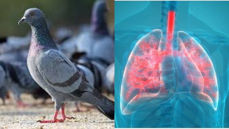 doctor explained about hypertensive pneumonia due to pigeon