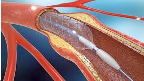 What is angiography Why is angiography performed cardiologist explains