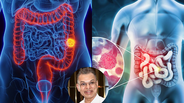 What is colon cancer? Can it be cured? Doctor Explains