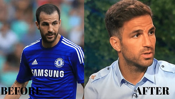 Footballers' Hair Transplants: A New Trend in Grooming