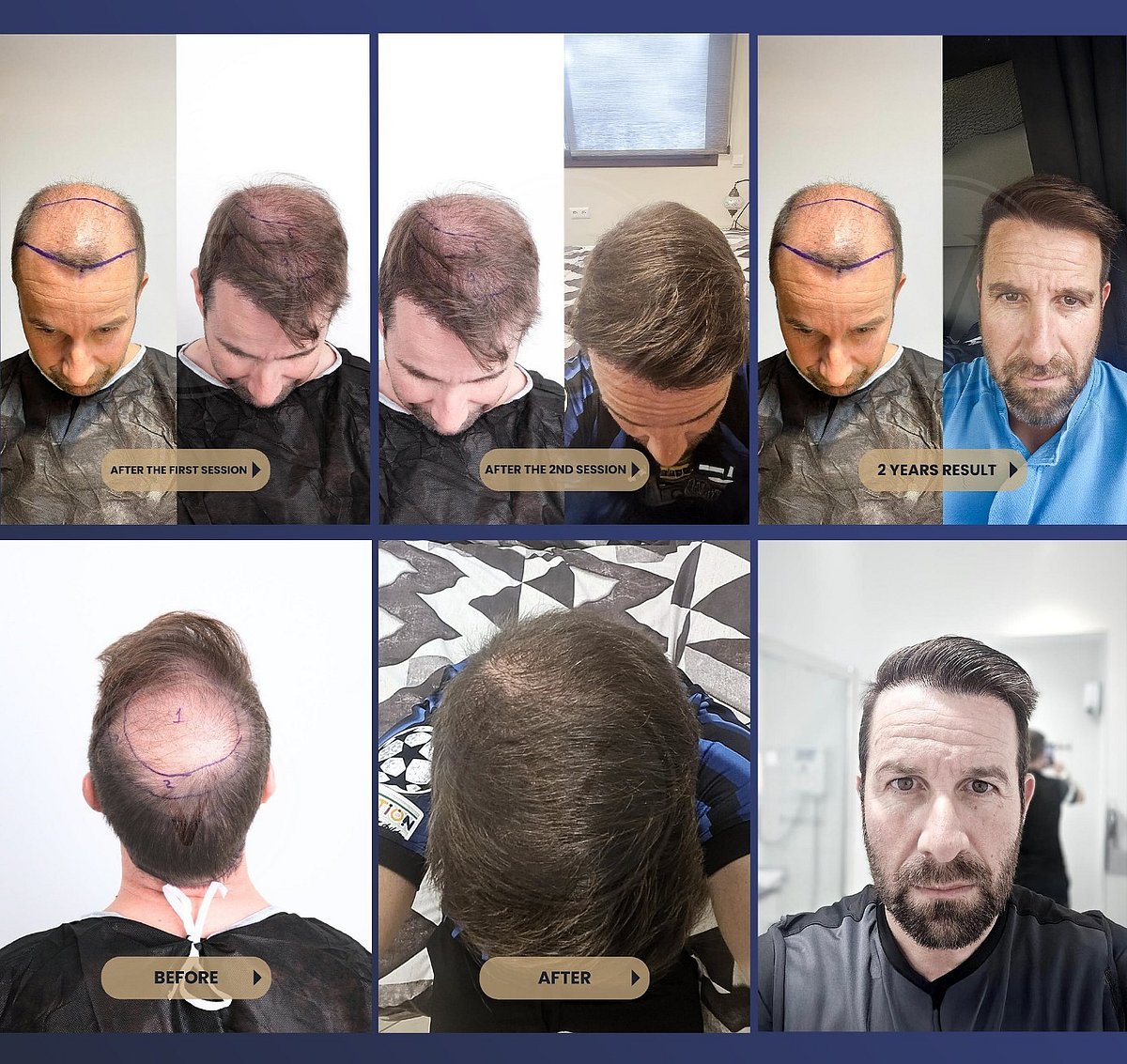 Why Turkey is the Top Choice for Affordable Hair Transplants