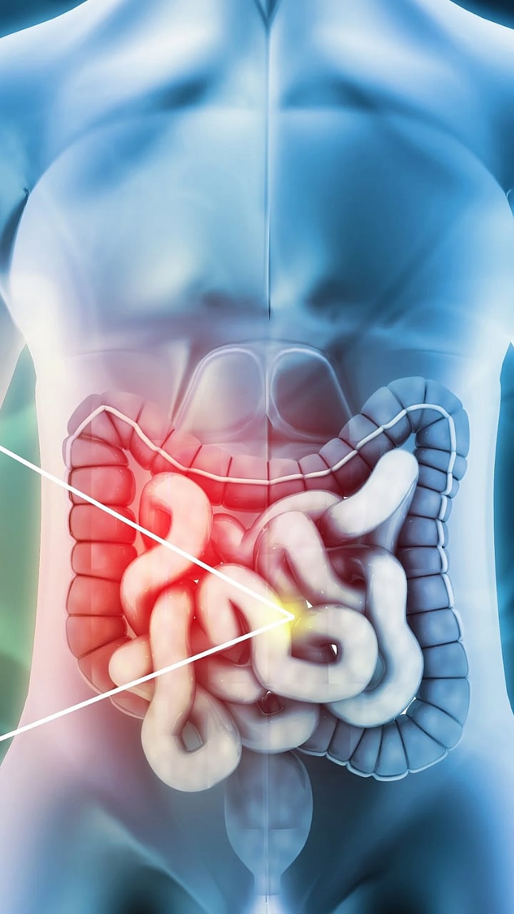 Colon cancer: हे 6 संकेत दिसले तर समजा आतड्यांचा कॅन्सर झालाय | If you ...