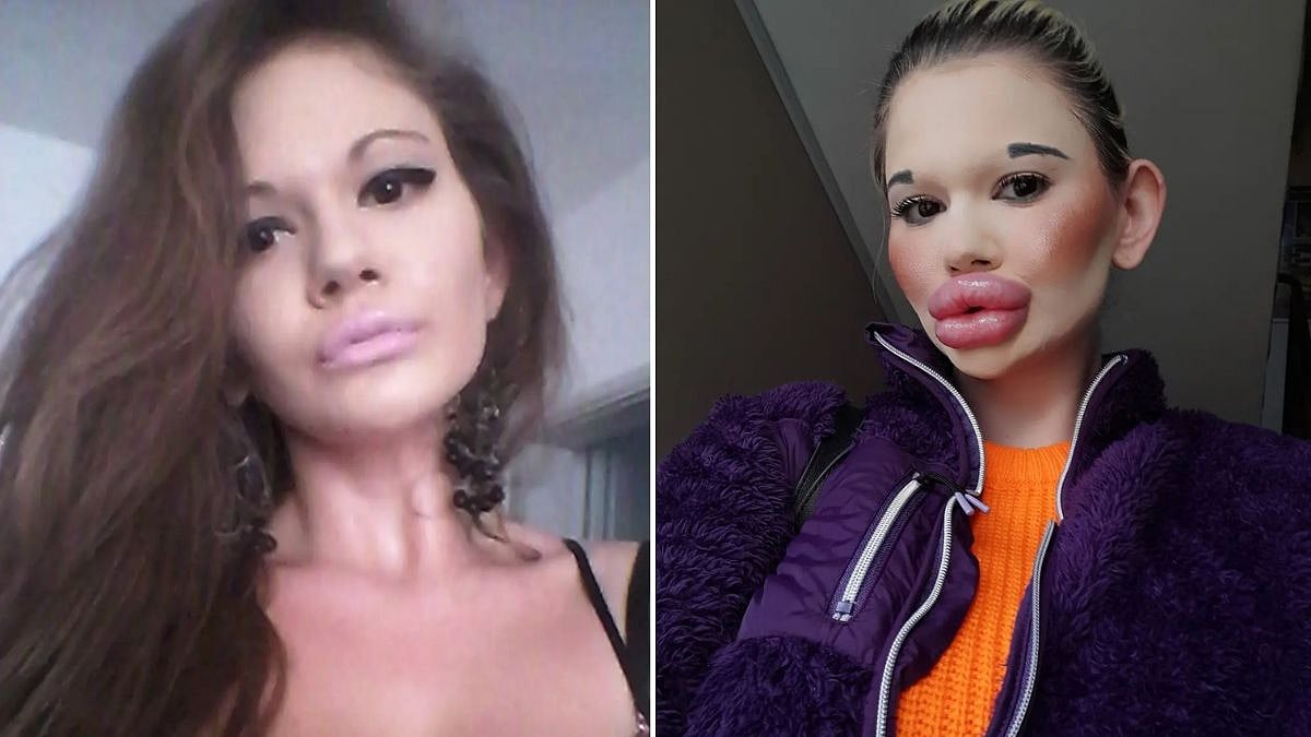 Women with Biggest Lips | अर्रर्र! सुंदर दिसण्याच्या नादात तरुणी काय ...