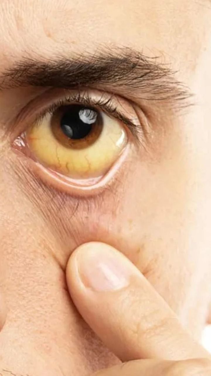 Jaundice Disease Symptoms: कावीळ झालीये कसं ओळखायचं? ही आहेत लक्षणे