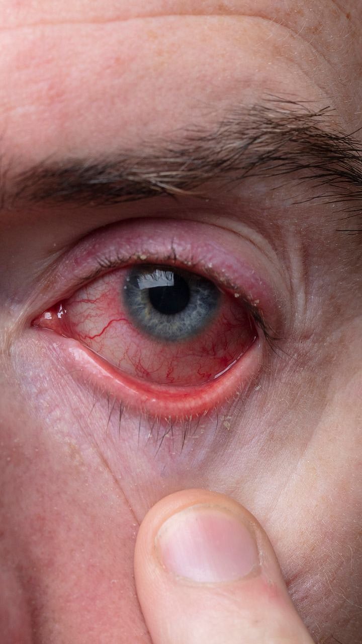 Red Eye: डोळे लाल होण्याचे कारण काय?