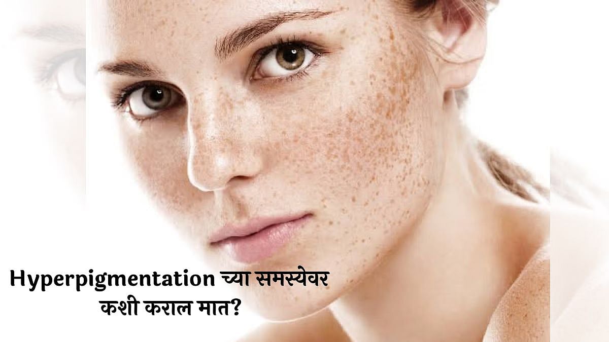 Hyperpigmentation च्या समस्येवर रामबाण ठरेल मध, अशाप्रकारे करा वापर ...