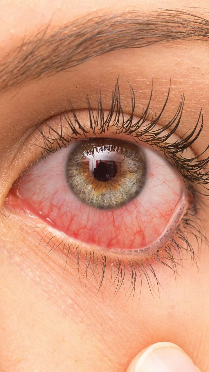 Eye Irritation Remedy : डोळे आल्यावर करा हे उपाय | eye irritation ...