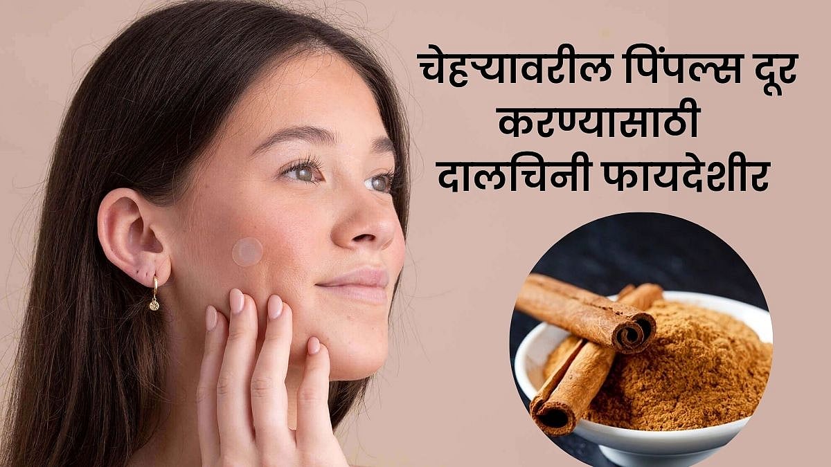 Pimple Free Skin: चेहऱ्यावरील पिंपल्स दूर करण्यासाठी दालचिनीचा 'हा ...