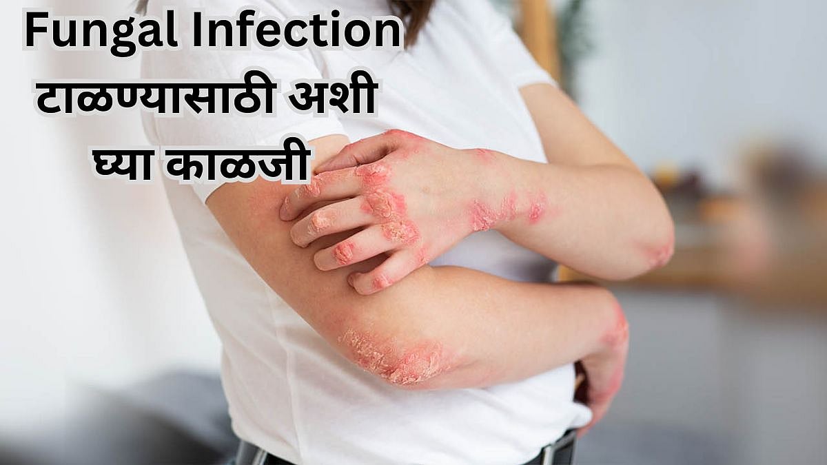 Fungal Infection : पावसाळ्यात तुम्हालाही होऊ शकतं Fungal Infection; अशी ...