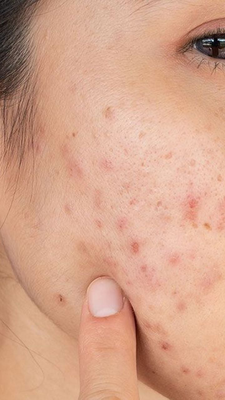 चेहऱ्यावरील पिंपल्स घालवण्यासाठी घरीच करा हे 5 उपाय, चेहरा एकदम क्लिन ...
