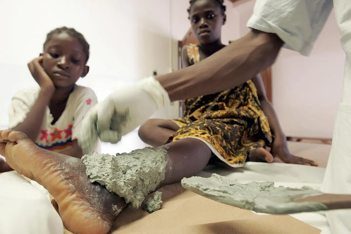 Explained: Flesh-eating bacteria—Symptoms, risks and importance of ...