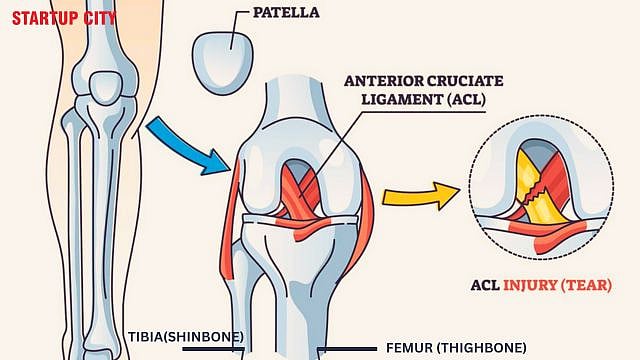 Guide to ACL Injuries