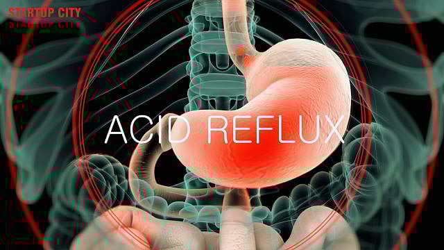 What is Acid Reflux?