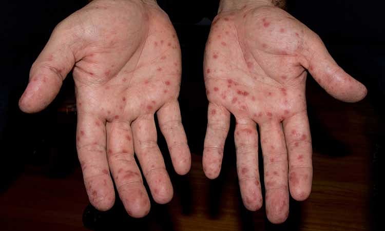 PH seeing surge in hand, foot, mouth cases