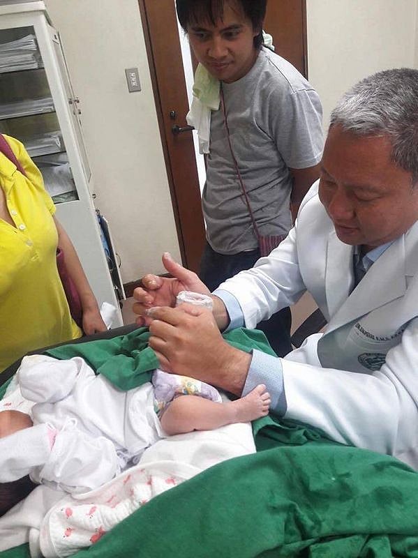 Early treatment for clubfoot pressed