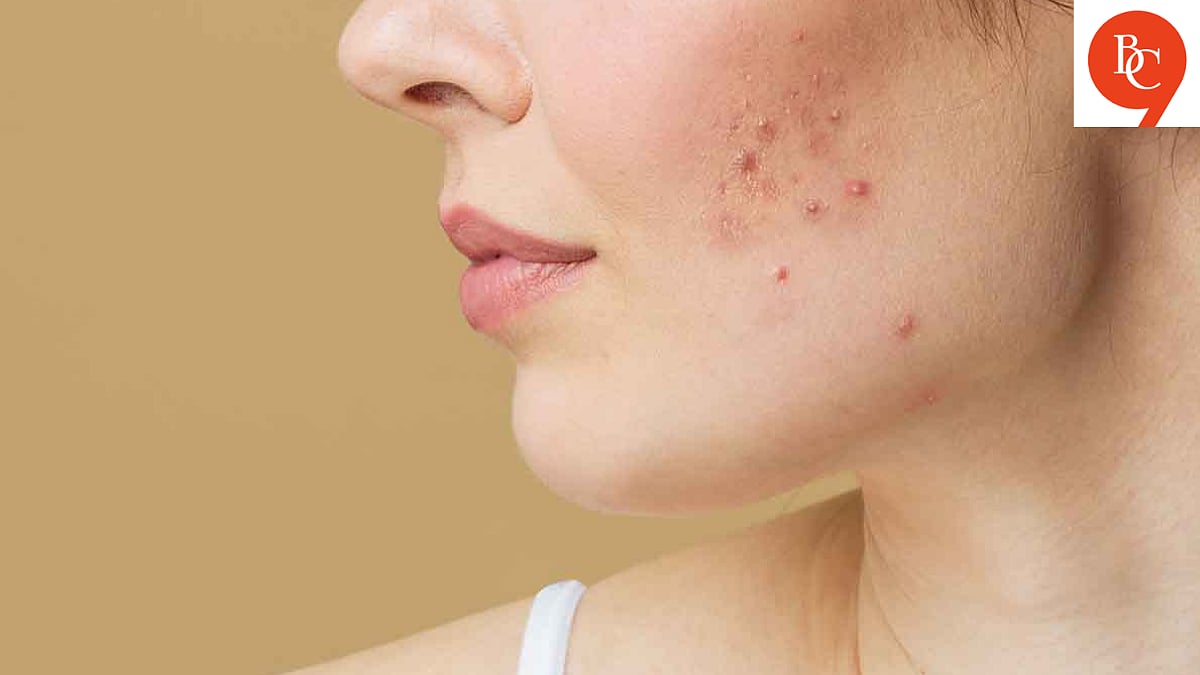 What is Hormonal Acne and How to Deal With It Naturally