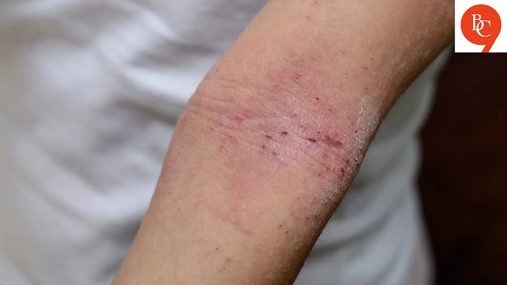 Monsoon Skin Woes? These Common Infections Need Your Attention