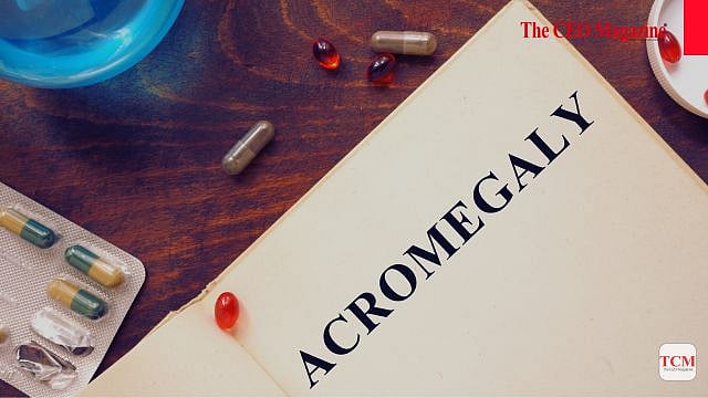 What is Acromegaly?
