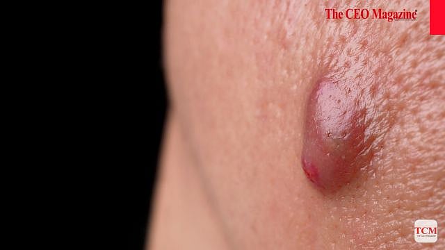 What is Abscess?
